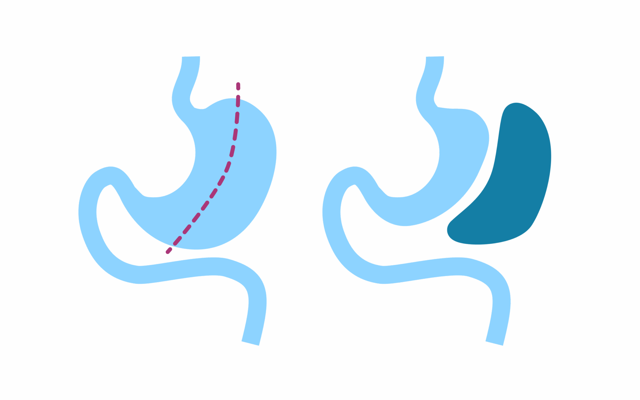 Gastric bypass och gastric sleeve jämförelse - CK Kirurgi